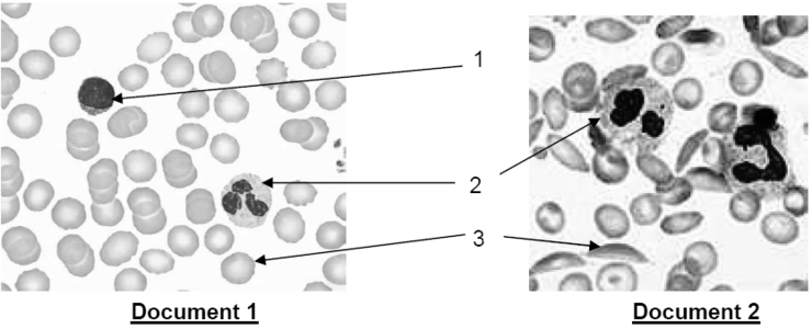 Image tst2s_bio_rde16i01 - La drépanocytose - Travailler sur des sujets ...